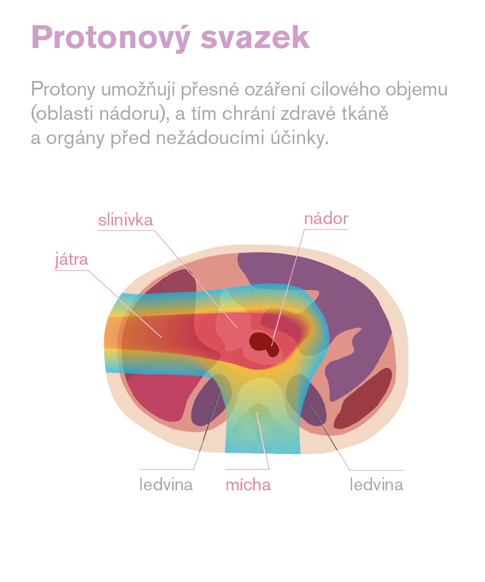 Proč zvolit protonovou léčbu - Protonové Centrum