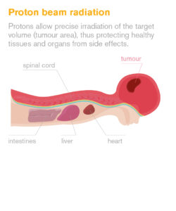 Why Choose Proton Therapy - Proton Therapy Center | Proton Therapy Center